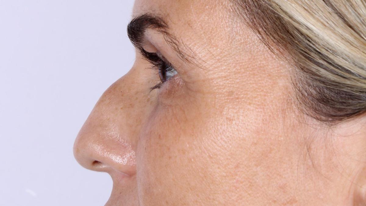 Comment corriger un nez crochu : Guide complet